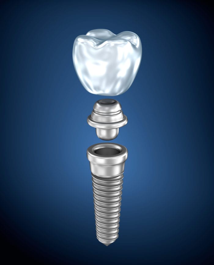 Single Dental Implant Plano TX | Tooth Implant Dallas Single Dental Implant Plano TX | Tooth Implant Dallas