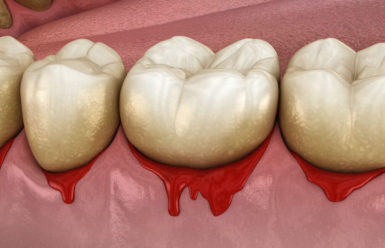 The Mouth-Body Connection | Plano, TX Periodontist